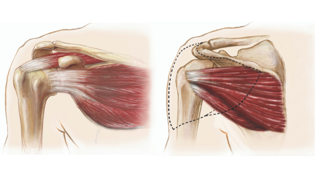 Rotator Cuff Tears - Florida